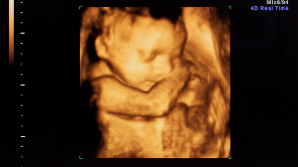 Advantages Of 3D 4D Ultrasounds Advantages Of 3D 4D Ultrasounds